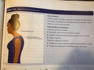 Upper Cross Syndrome - Breakdown (2025)